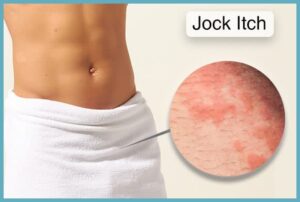 Fungal Skin Infections Causes And Cure All Things Gud